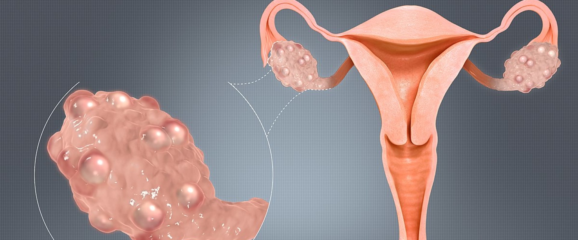 Understanding Polycystic Ovary Syndrome (PCOS) and Hormone Replacement ...
